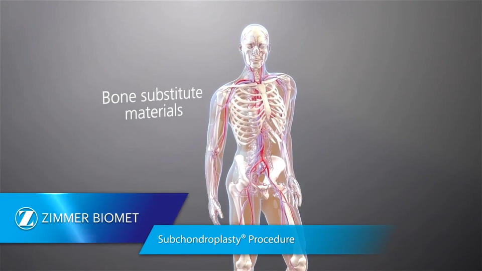 AccuFill® Bone Substitute Material for the Subchondroplasty® Procedure ...