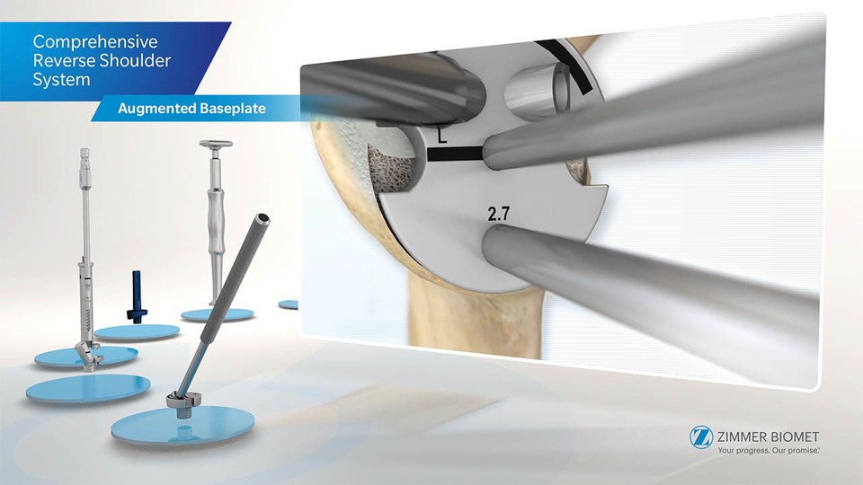 Comprehensive Reverse Shoulder System