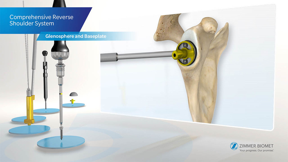 Comprehensive Reverse Shoulder featuring Mini Baseplate