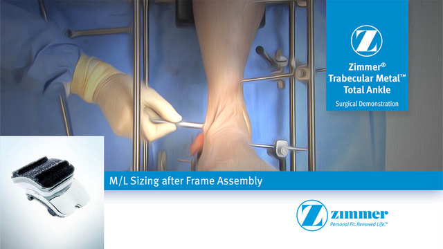 M/L Sizing after Frame Assembly for the Zimmer® Trabecular Metal™ Total ...