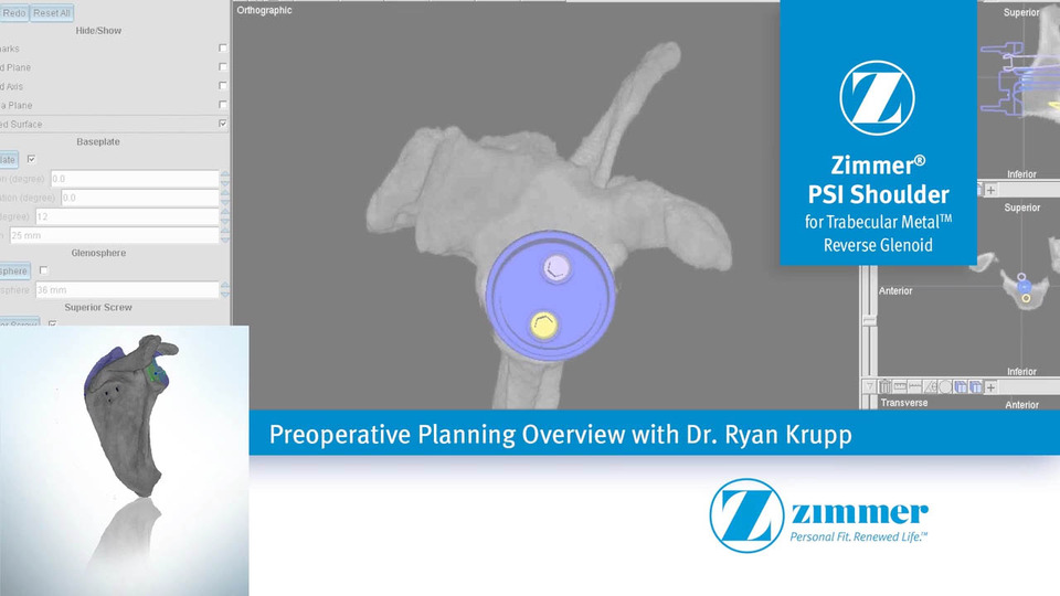 Zimmer® PSI Shoulder for Trabecular Metal™ Reverse Glenoid - Superiorly ...
