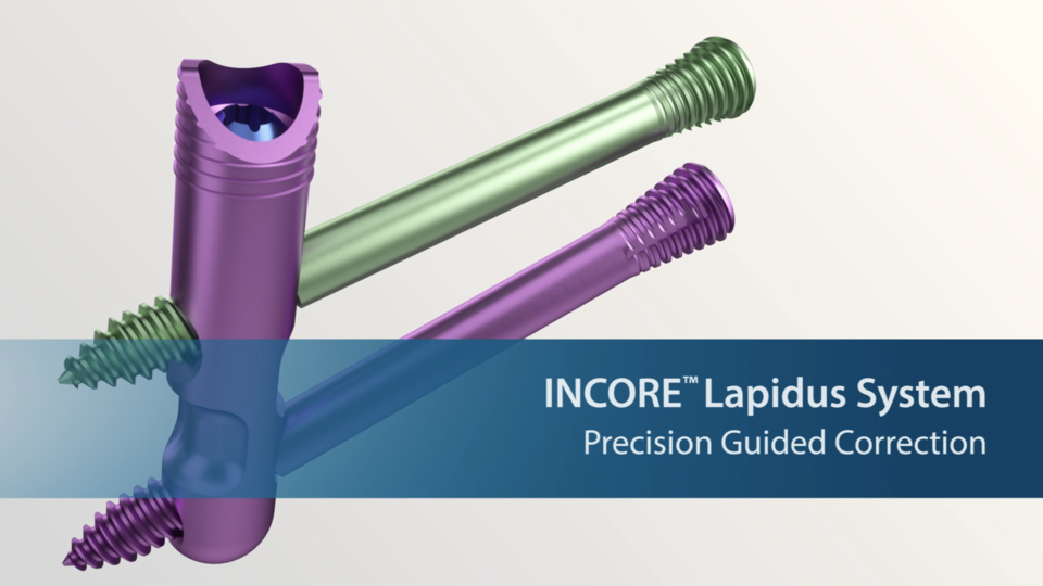 INCORE™ Lapidus System Precision Guided Correction