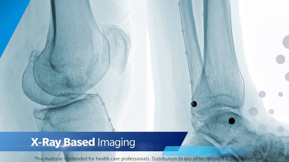 ROSA® Knee Surgical Technique Overview