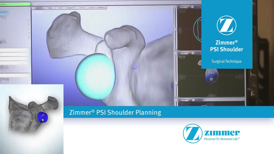 Zimmer® PSI Shoulder Planning