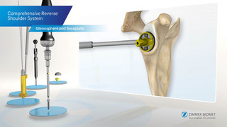 Comprehensive Reverse Shoulder System